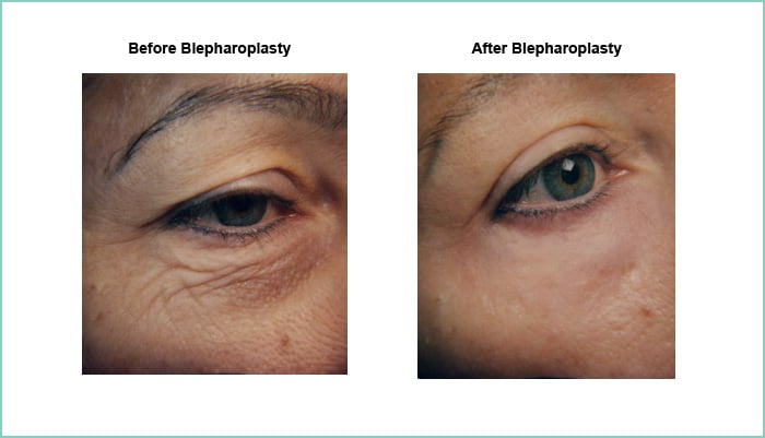 Blepharoplasty (Eyelid) Surgery Austin, Texas | CTD