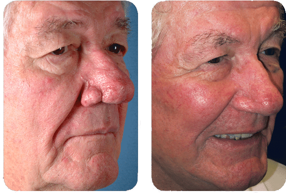 Rhinophyma Treatment & Removal Austin, Texas | CTD