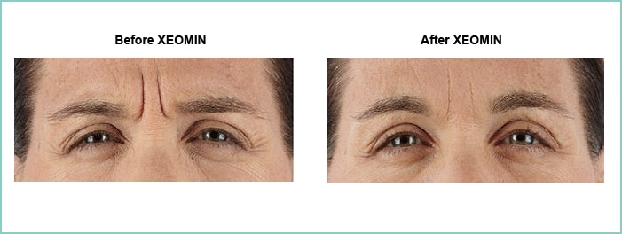 Xeomin Before And After Lips